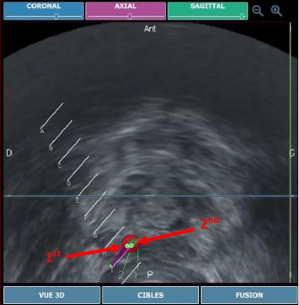 Transperineal Biopsy Tips and Tricks | Koelis Academy
