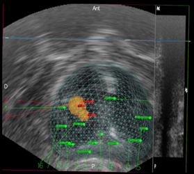 What is the Gleason Score? | KOELIS