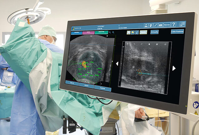 Fusion Prostate Biopsy with MRI-Ultrasound Guidance