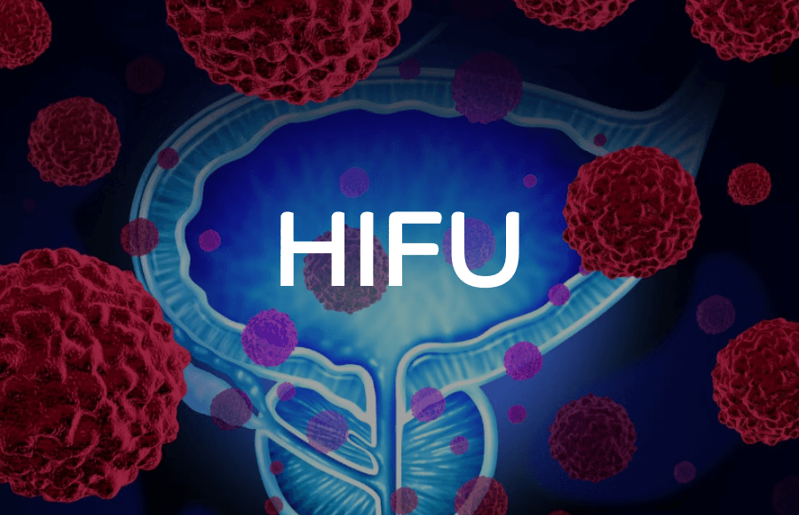 HIFU Prostate Cancer Treatment - Benefits, Risks & More