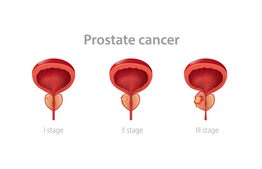 What is the Life Expectancy After Prostate Removal?