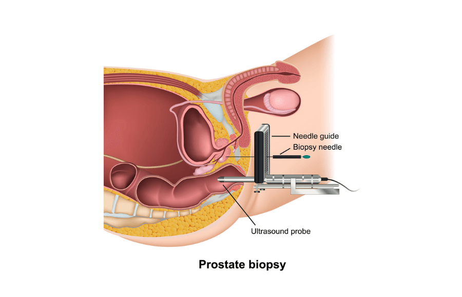 Transperineal vs. Transrectal Prostate Biopsy | KOELIS
