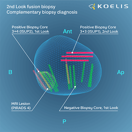 ProMap Focal Therapy | KOELIS