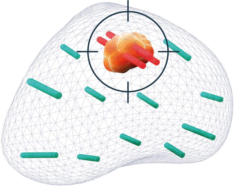 ProMap Focal Therapy | KOELIS