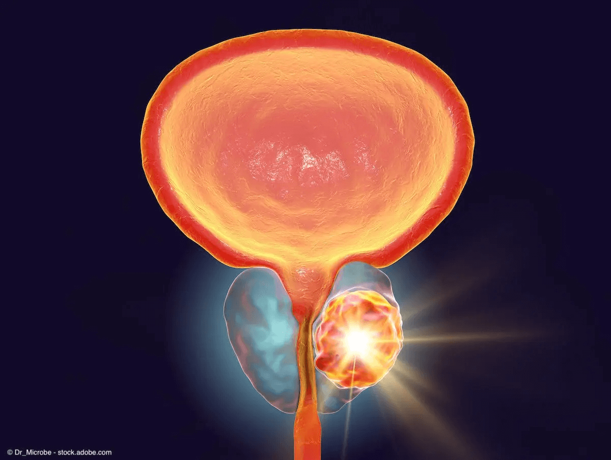 Collaboration aims to streamline prostate MRI interpretation, fusion ...