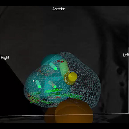 ProMap Focal Therapy | KOELIS