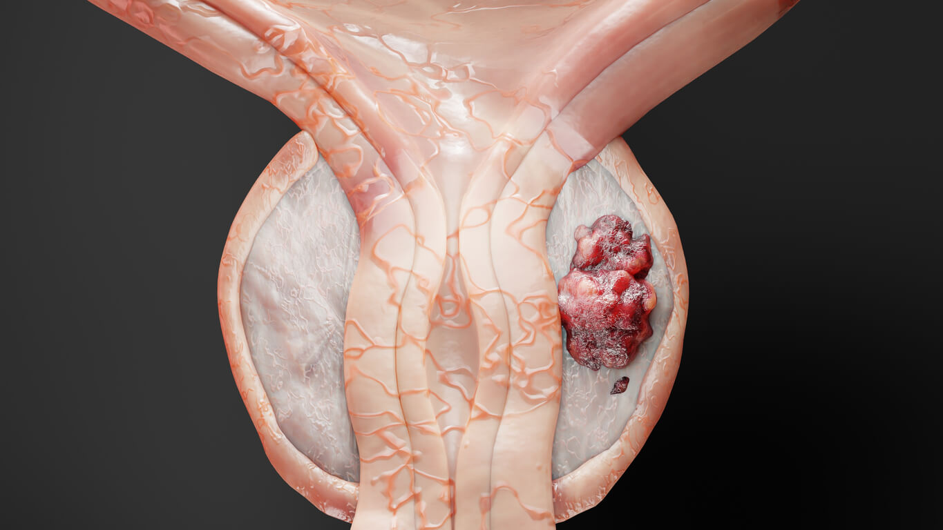 How Long Can You Live With Stage 4 Prostate Cancer?