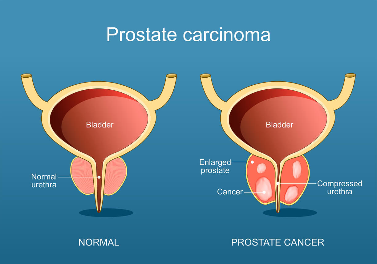 Prostate Biopsy Procedure: Video, Recovery & Pain