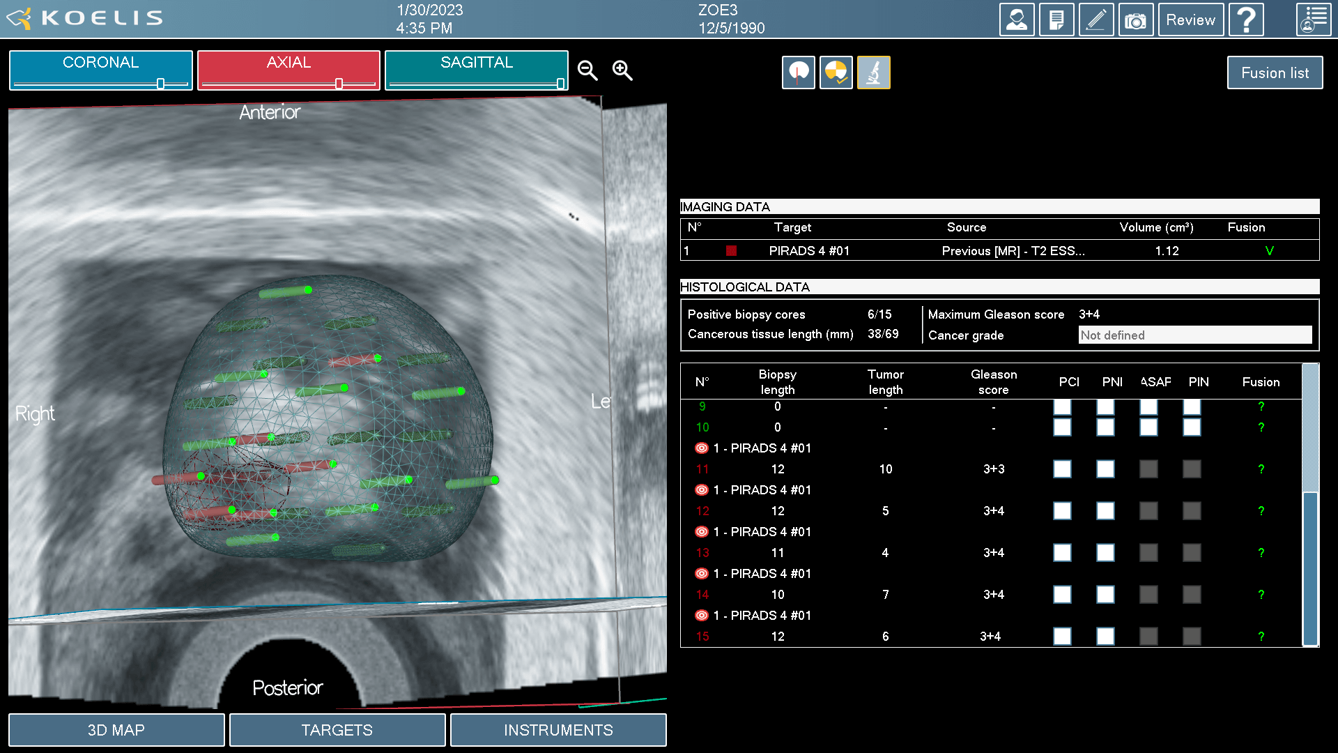 ProMap Focal Therapy | KOELIS