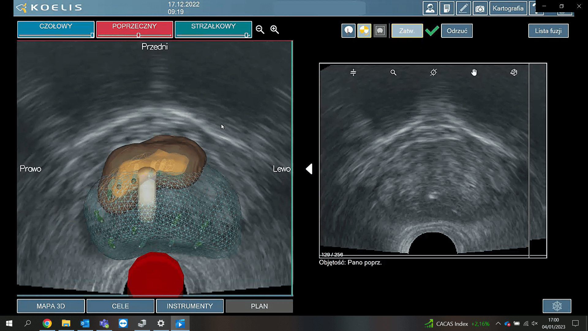 ProMap Focal Therapy | KOELIS