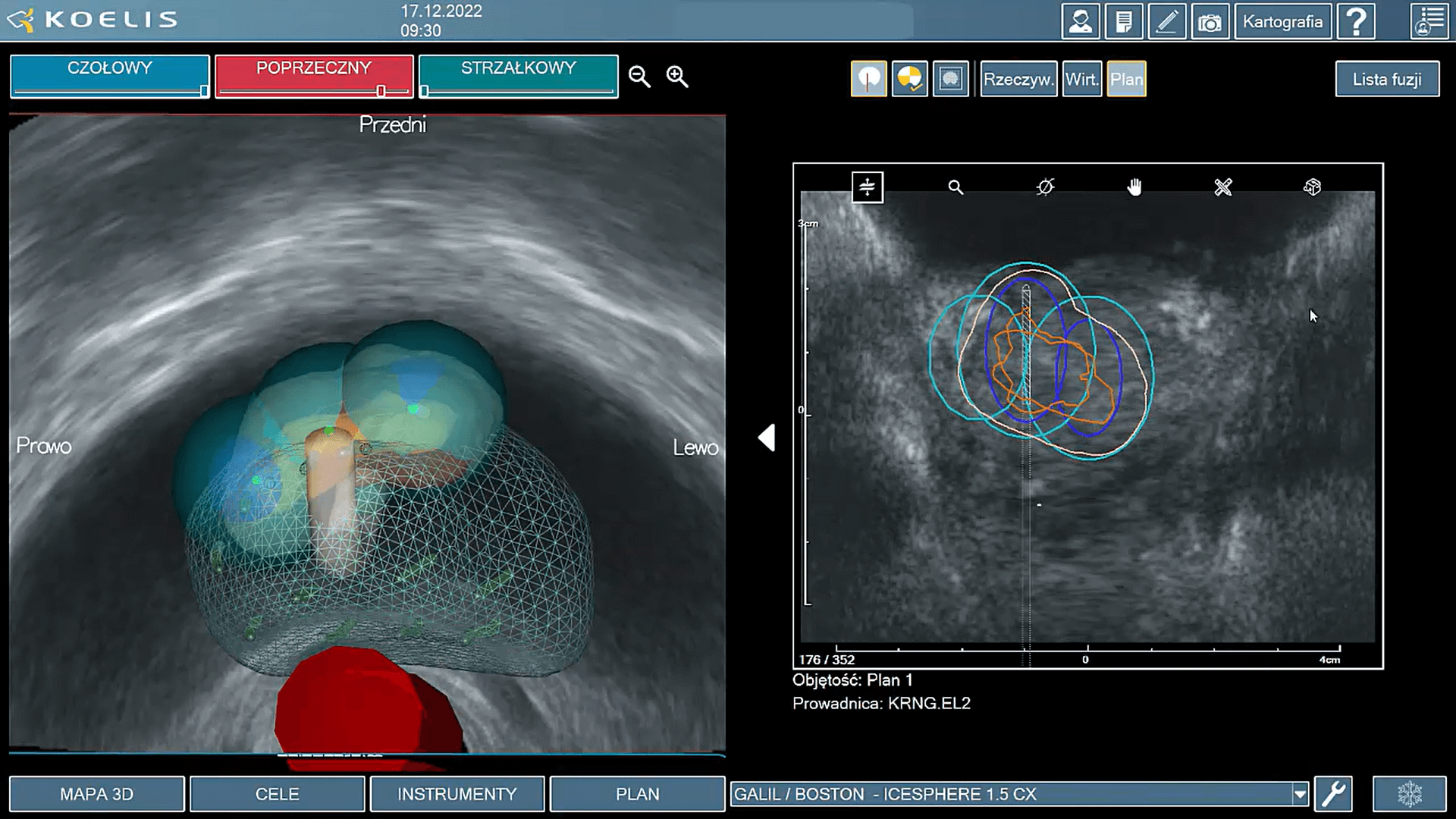 ProMap Focal Therapy | KOELIS