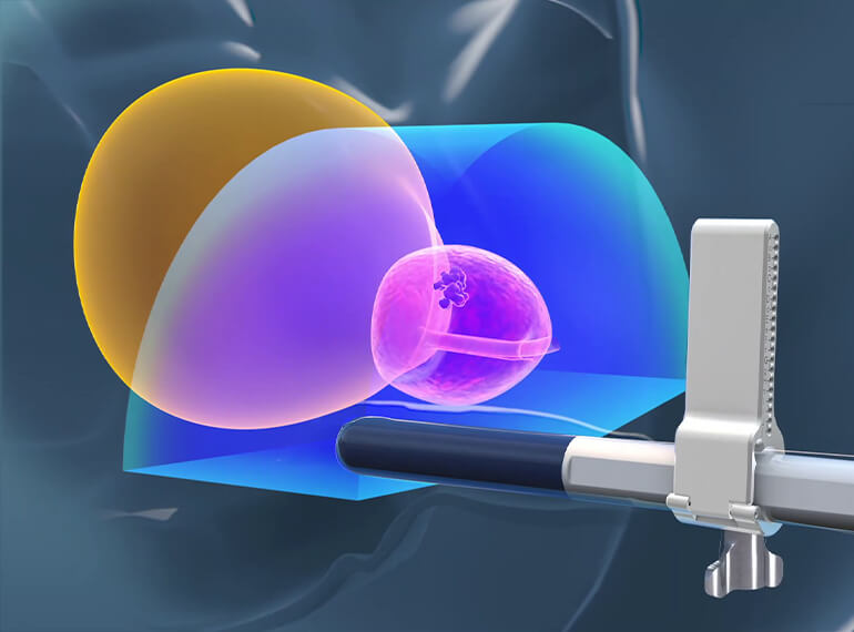 Transperineal Biopsy for Prostate Cancer Detection | KOELIS