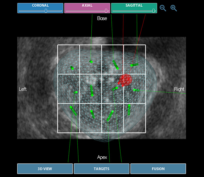 Transrectal Biopsy for Prostate Cancer Detection | KOELIS