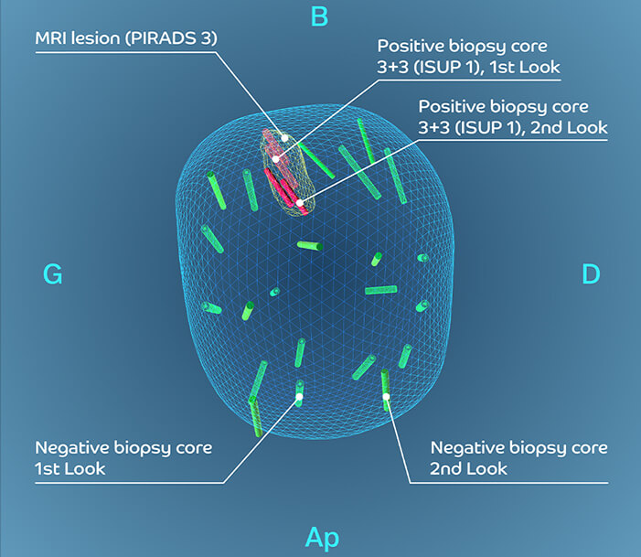 Transrectal Biopsy for Prostate Cancer Detection | KOELIS