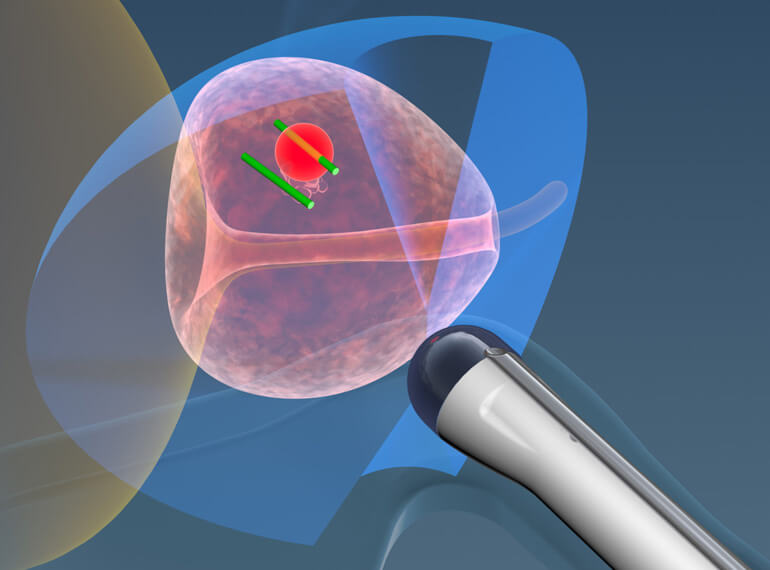 Transrectal Biopsy for Prostate Cancer Detection | KOELIS