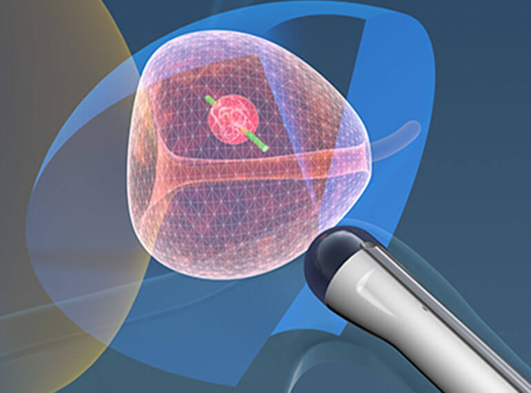 Transrectal Biopsy for Prostate Cancer Detection | KOELIS
