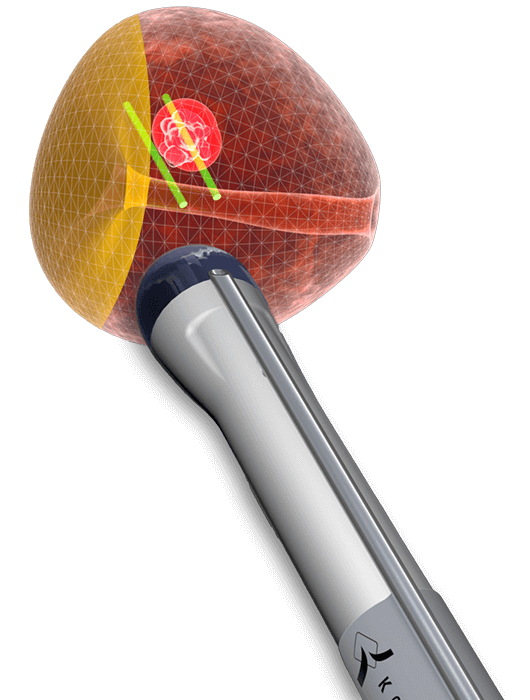 Transrectal Prostate Ultrasound Probes | KOELIS