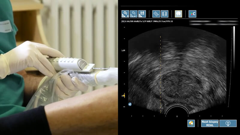 MRI / Ultrasound Fusion Guided Prostate Biopsy | KOELIS