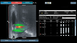 KOELIS Trinity® MRI TPUS Biopsy System | KOELIS