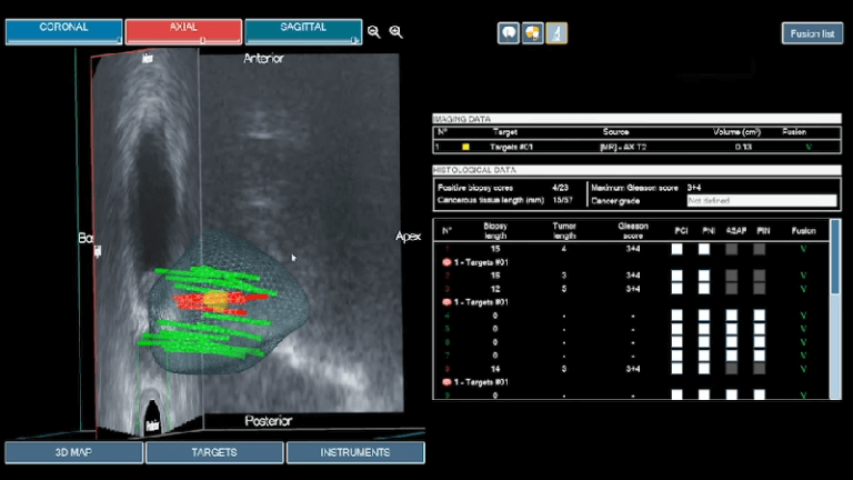 KOELIS Trinity® MRI TPUS Biopsy System | KOELIS