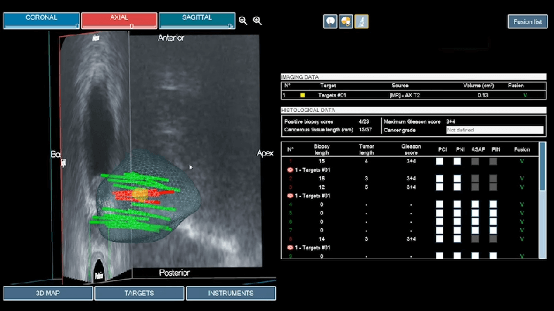 KOELIS Trinity® MRI TPUS Biopsy System | KOELIS
